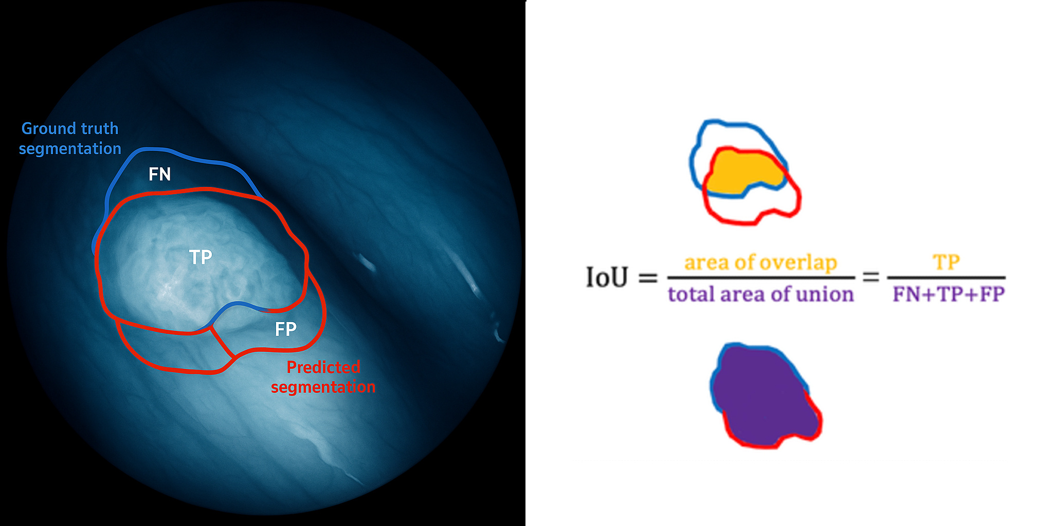 IoU boosts AI skin cancer detection accuracy, saving lives.